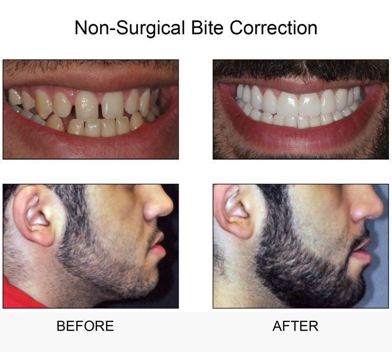 Bite Correction & Malocclusion Treatment | Westcoast Dental