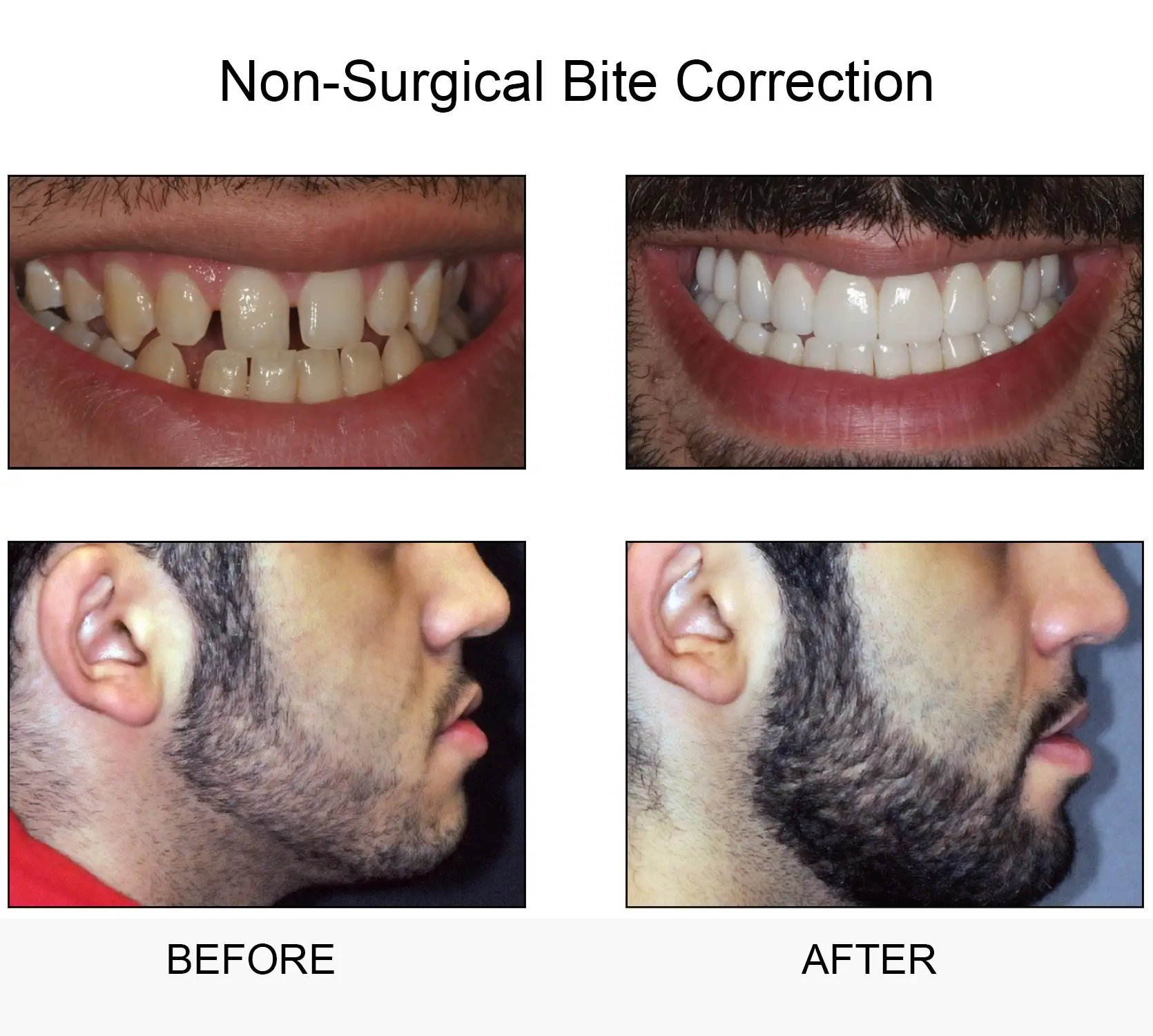 Bite Correction & Malocclusion Treatment | Westcoast Dental